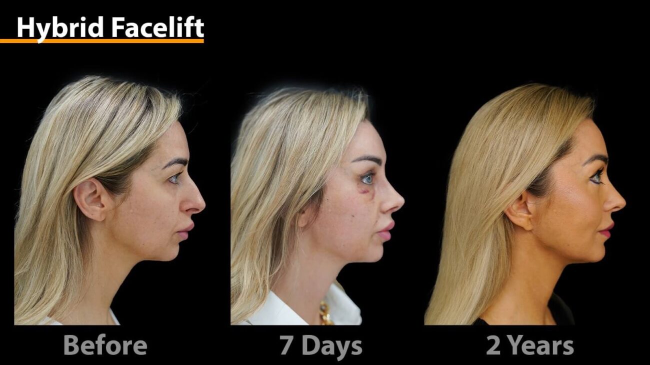 Hybrid Face Lift – Mooi Clinic