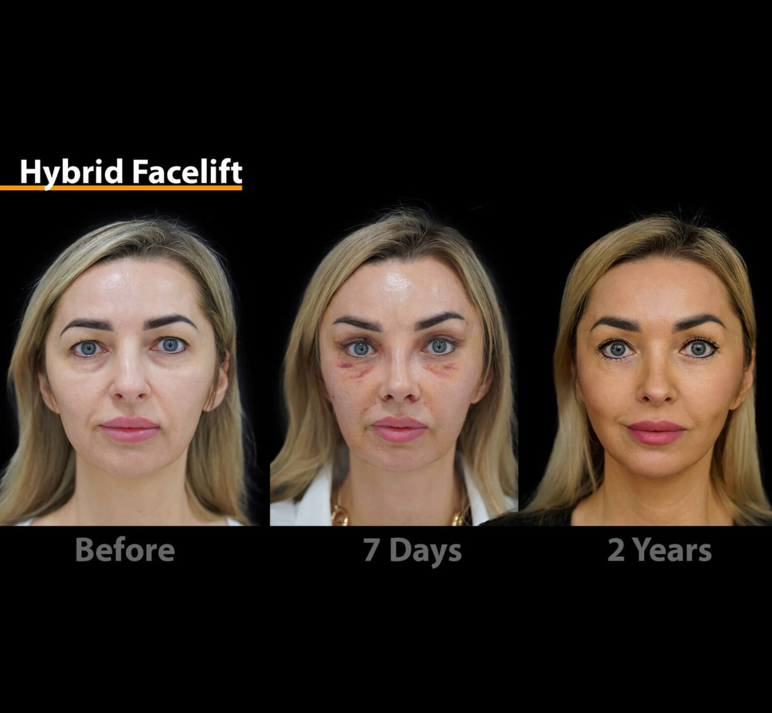 Hybrid Face Lift – Mooi Clinic